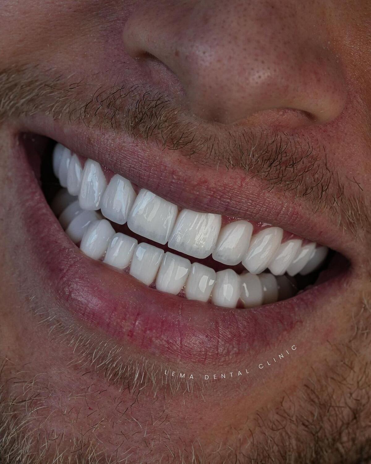 Dental Crowns For Enhancing Smiles 2025 - Lema Clinic