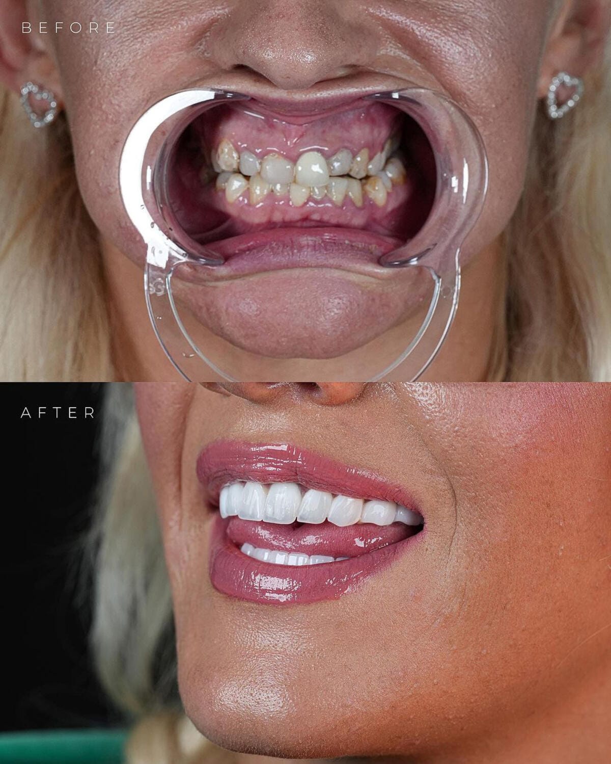 🦷 Karies Und Zahnhoehlen 2025 - Lema Dental Clinic Türkei