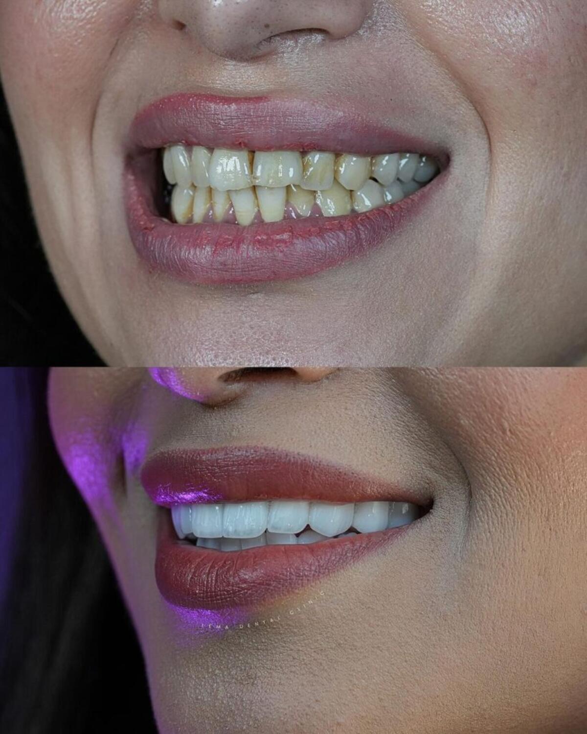 5 Ways To Get Rid Of Coffee Stain on Teeth 2025