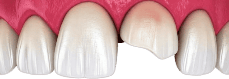Understanding Cracked Tooth: Causes, Symptoms, and Solutions