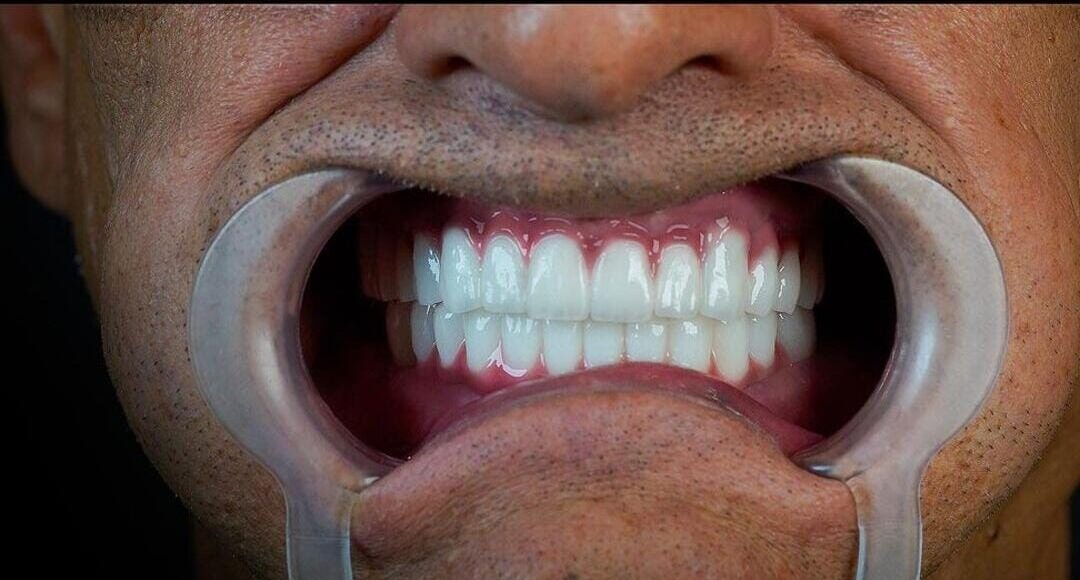 How Long Does It Take to Get All-on-4 Dental Implants in Turkey? | LEMA