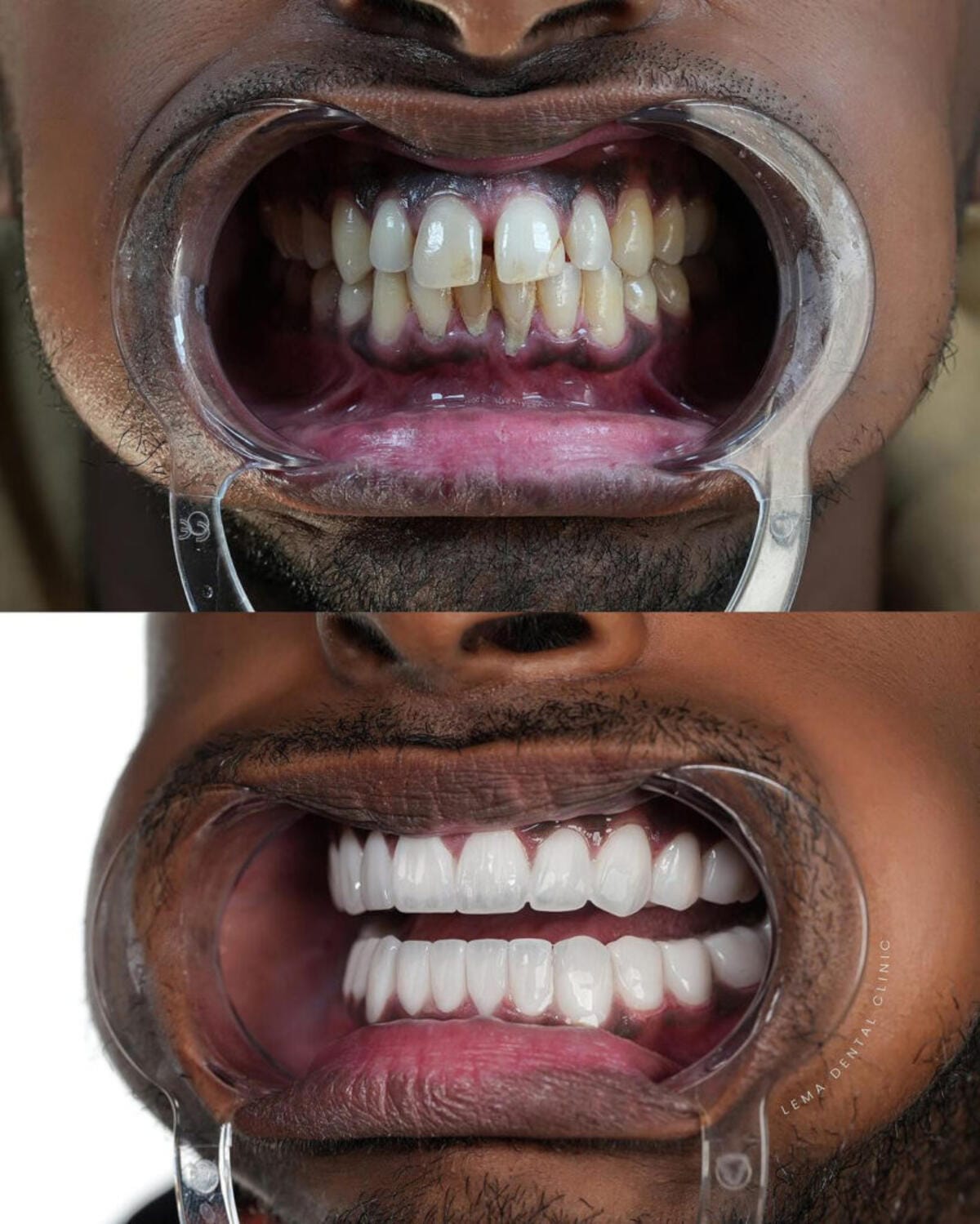 Diastema Causes and Treatments 2025 - Lema Dental Clinic