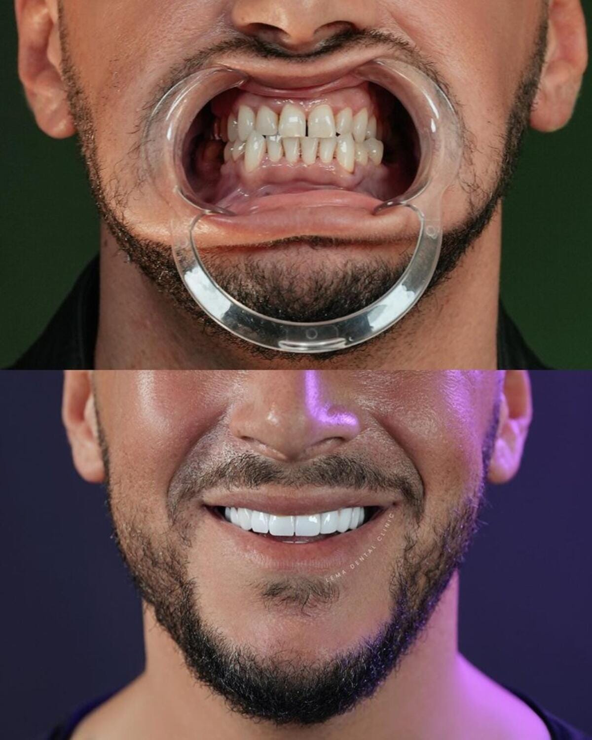 Diastema Causes and Treatments 2025 - Lema Dental Clinic