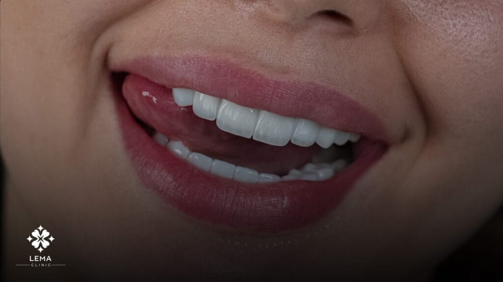 Diastema Causes And Treatments 2025 Lema Dental Clinic