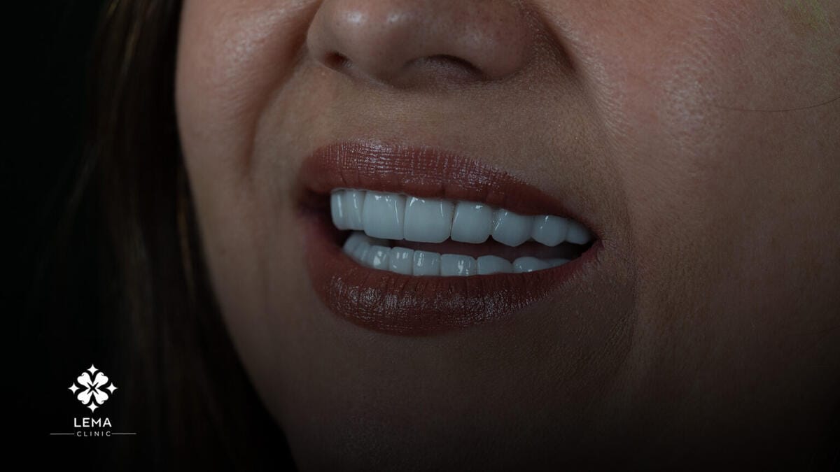 Emax Dental Veneers Overwiev 2025 - Lema Dental Clinic