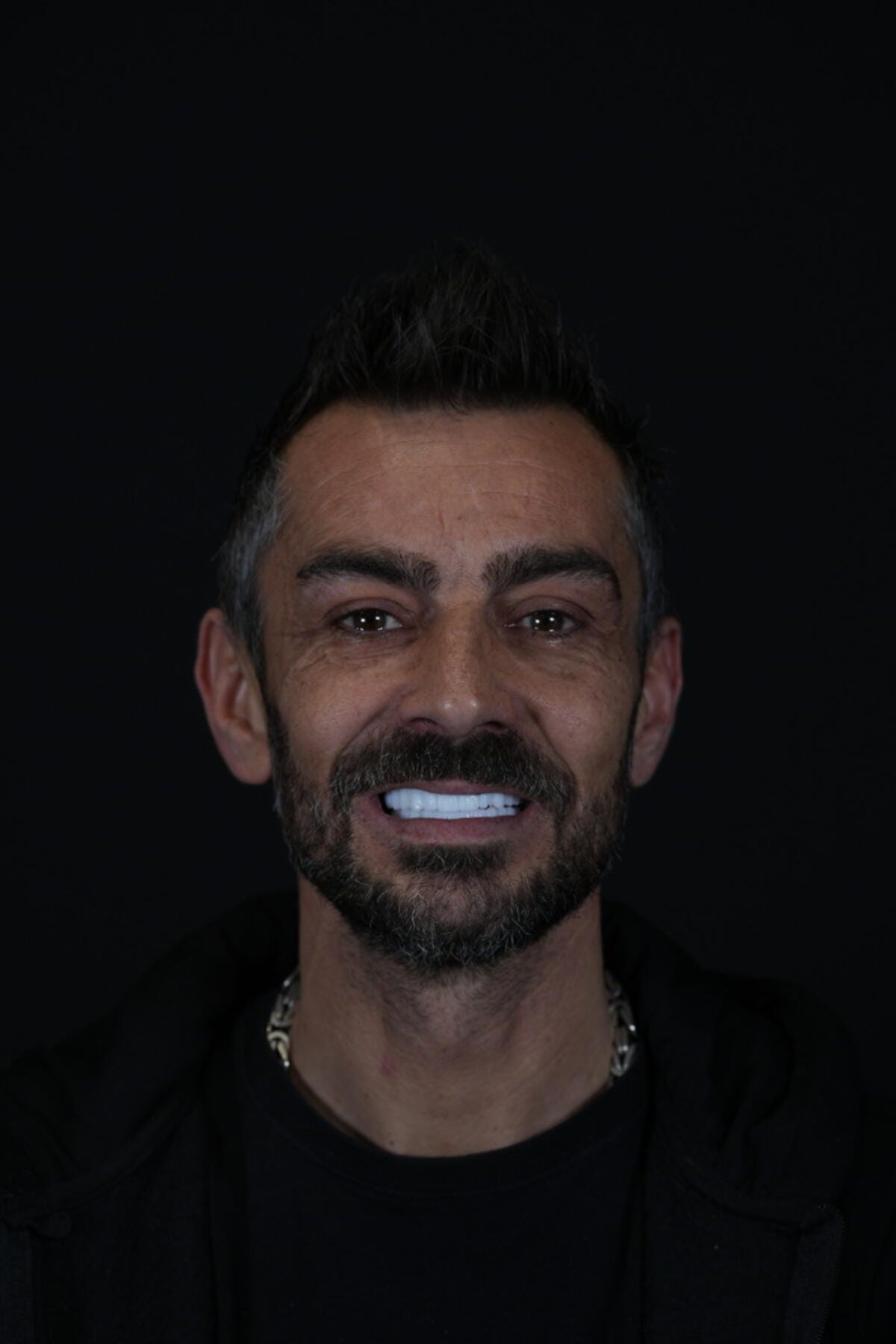 Emax Dental Veneers Overwiev 2025 - Lema Dental Clinic