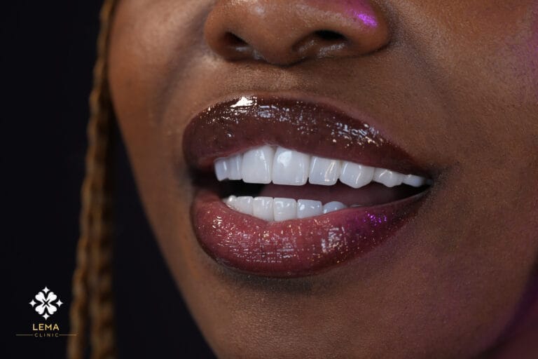 Gummy Smile Effective Treatment Methods