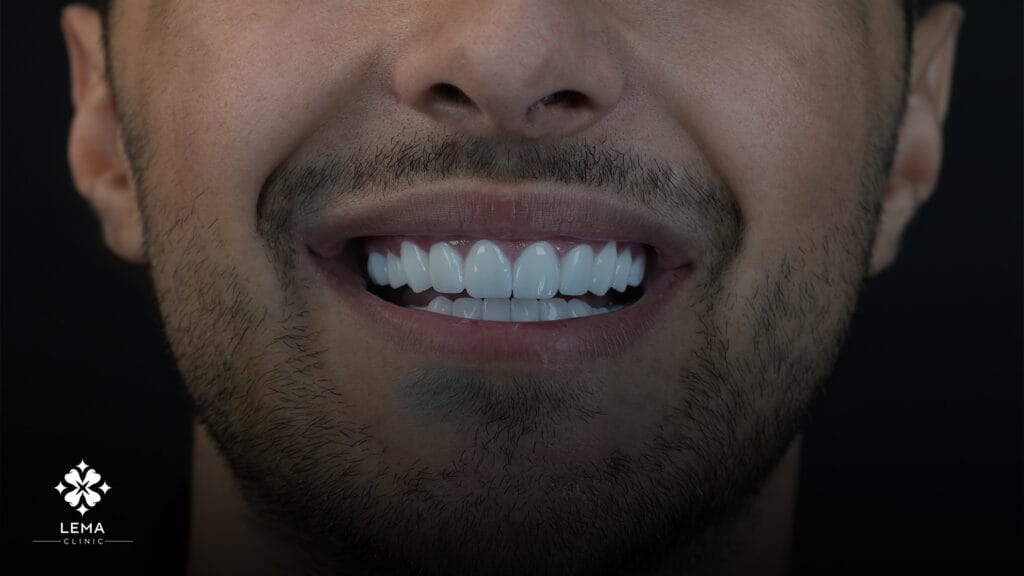 Perfect Smile Tips And Tricks 2025 - Lema Dental Clinic