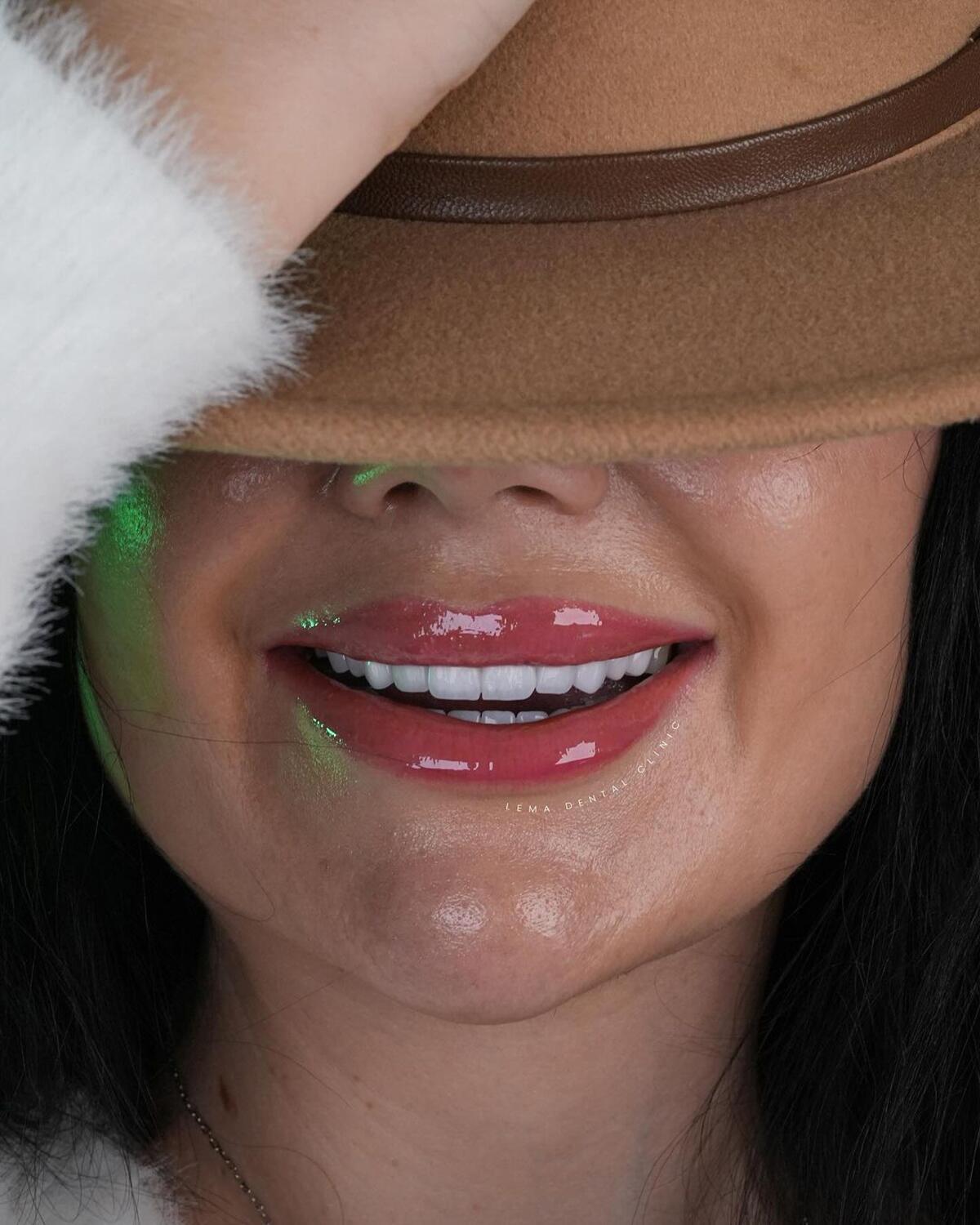 🦷Everything You Need To Know About Turkey Teeth | LEMA