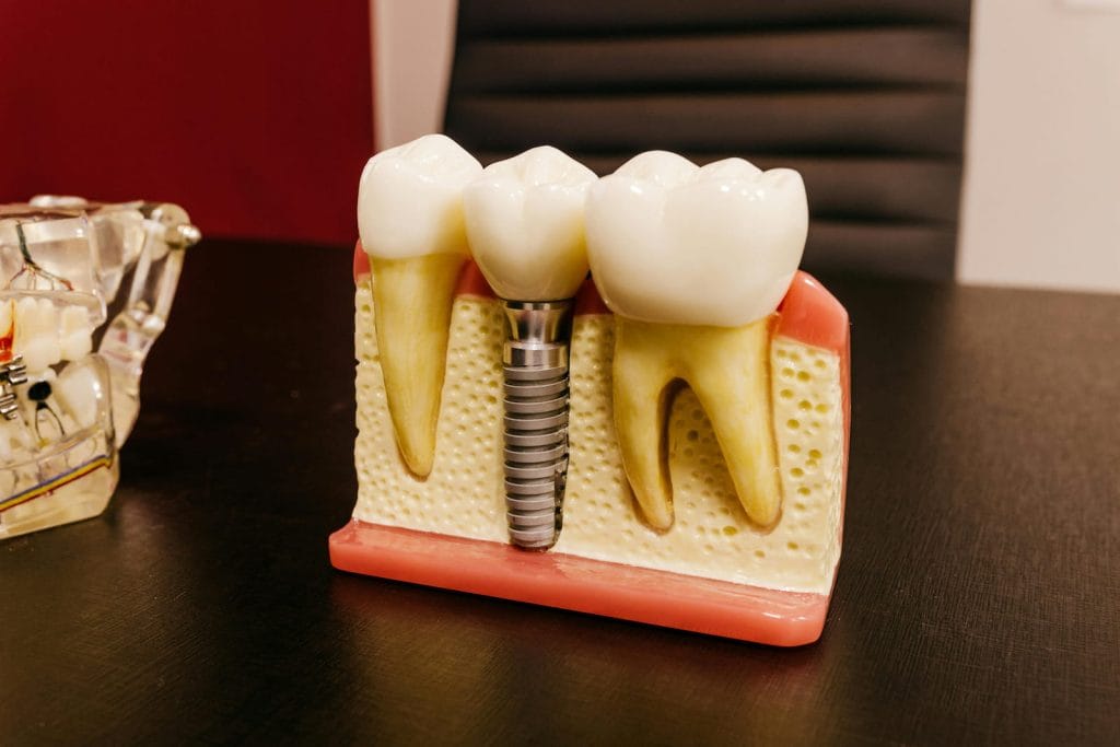 How long after the filling can you eat? Things to Consider