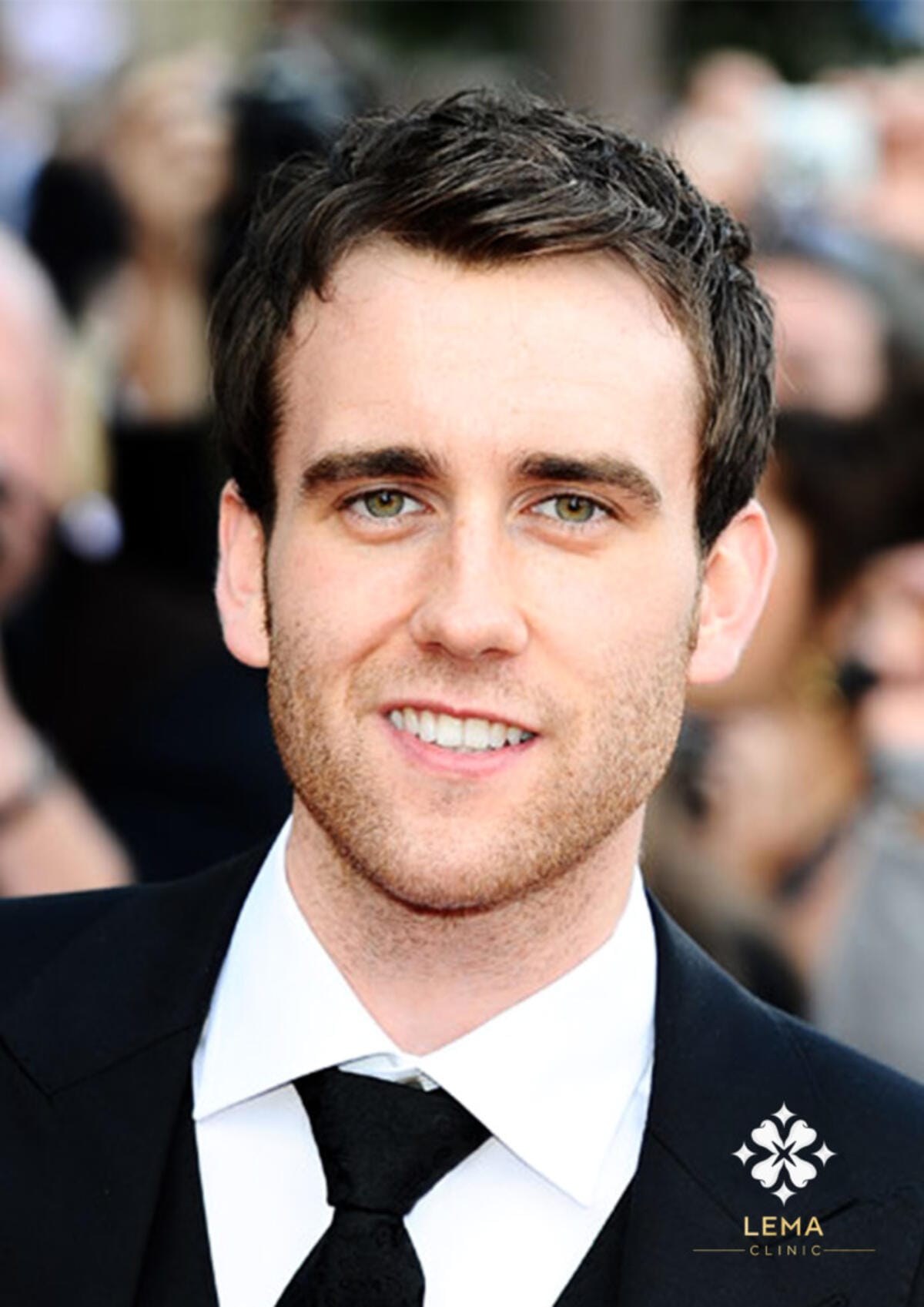 Matthew Lewis Teeth Makeover 2025 - Lema Dental Clinic