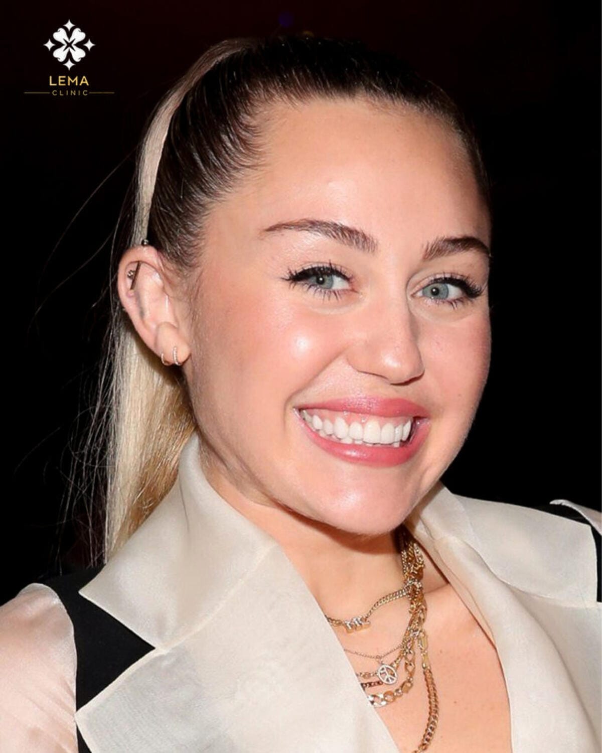 Miley Cyrus Teeth Journey Unveiled - Lema Dental Clinic 2024
