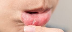 Afte bucale: Cauze și tratamente eficiente | Lema Dental Clinic