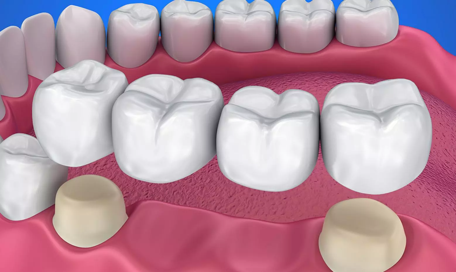 Types Of Dental Crowns And Their Costs - Lema Dental Clinic