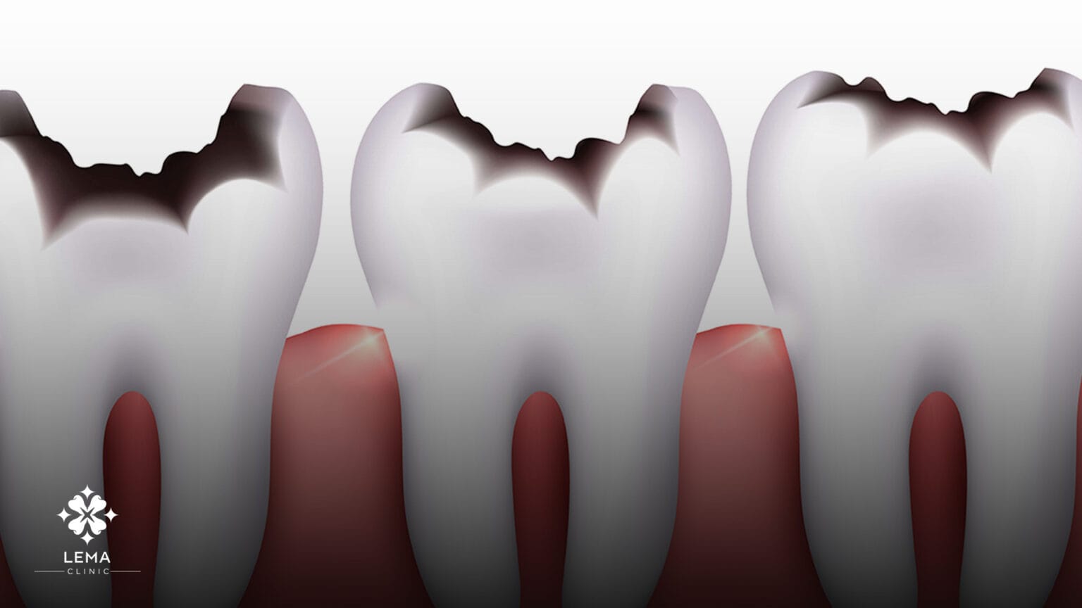 👶Was ist ein Abszessierter Zahn? Symptome, Behandlung | Lema Dental Clinic