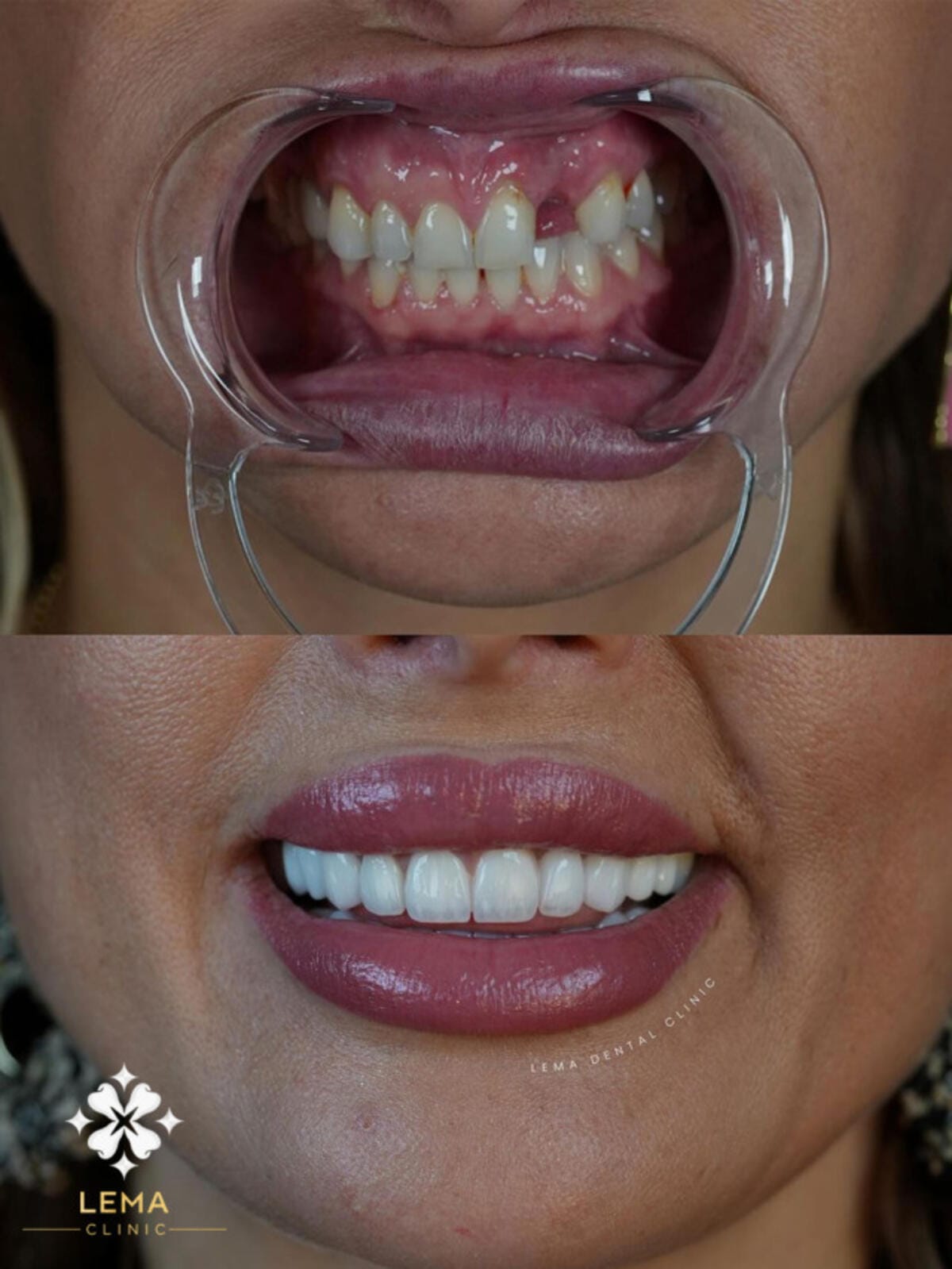 Tooth Extraction Process And Aftercare - Lema Dental Clinic