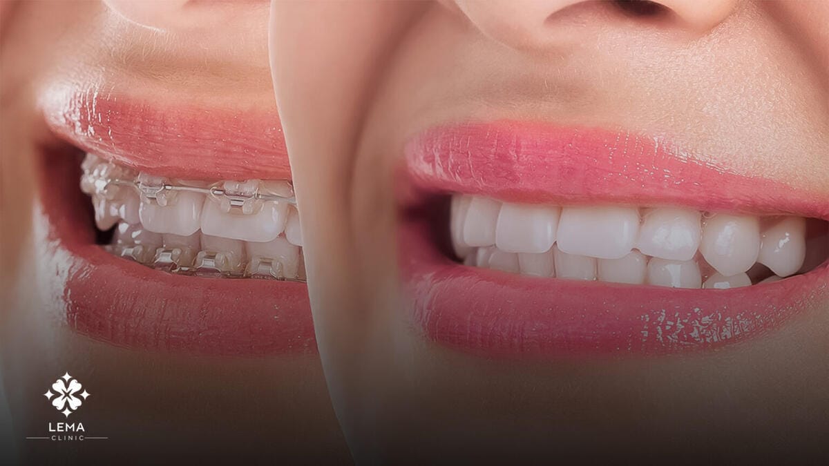 🦷 Braces vs. Invisalign: Which Works Best for You? | LEMA