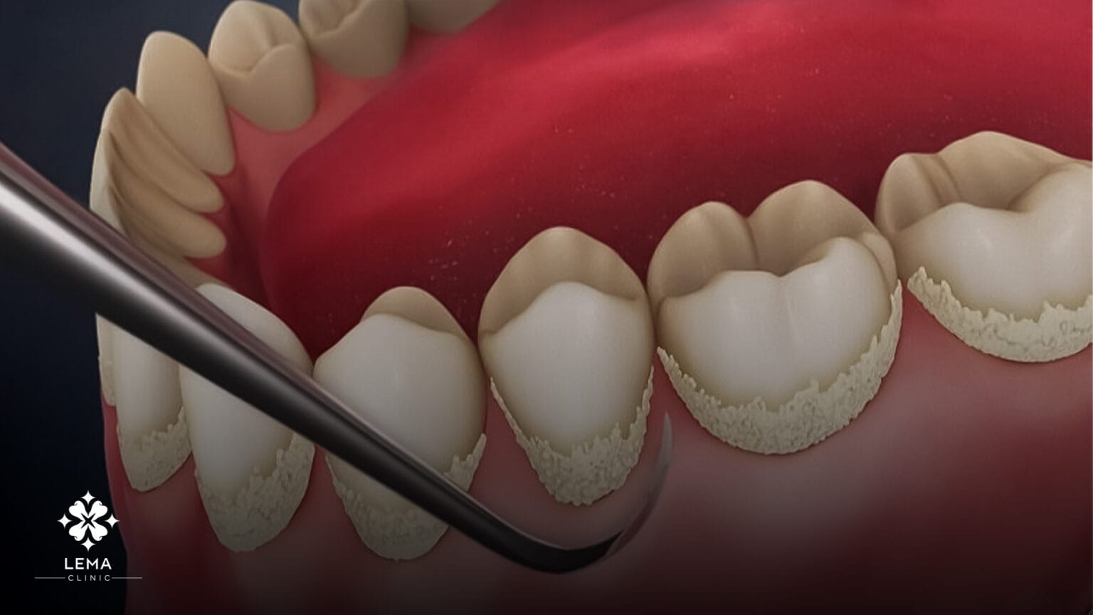 🦷 Hvordan fjerne tannstein på tenner hjemme