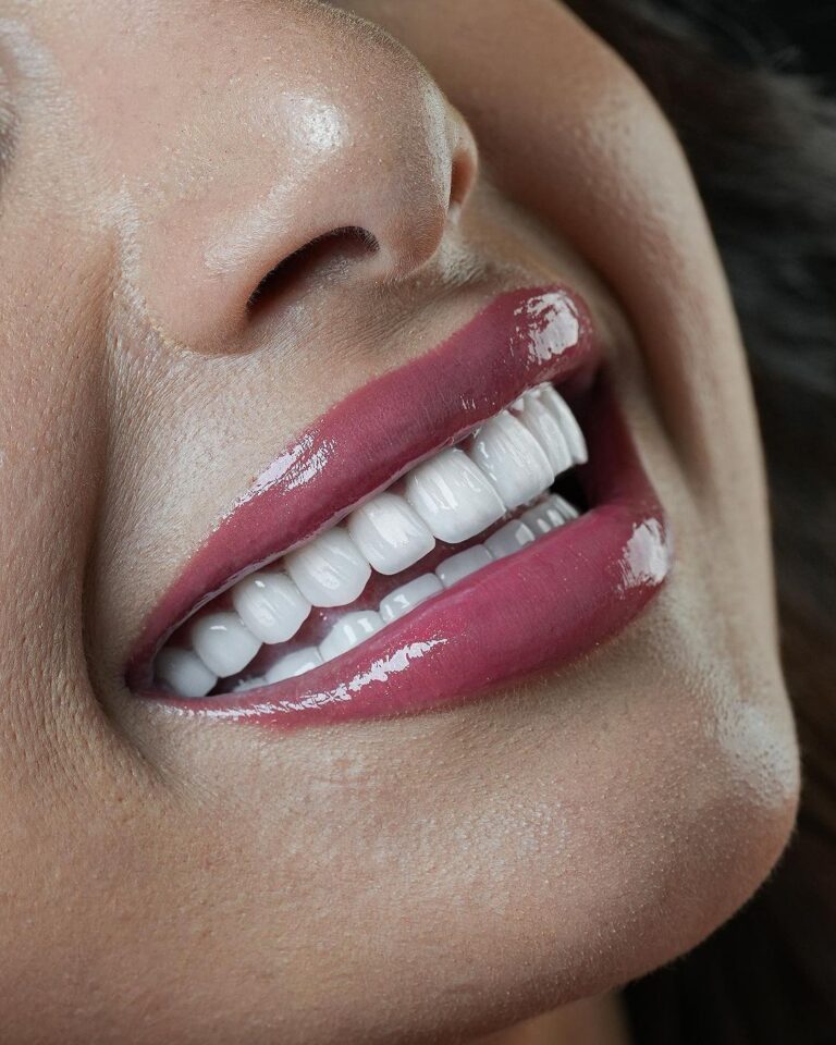 D6058 Dental Code: Long-Lasting and Secure Implant Crowns | LEMA