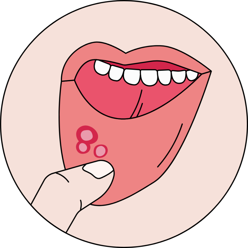 Qu’est-ce qu’un aphte et comment le traiter ? - Lema Dental Clinic Qu’est-ce qu’un aphte et comment le traiter ? - Lema Dental Clinic